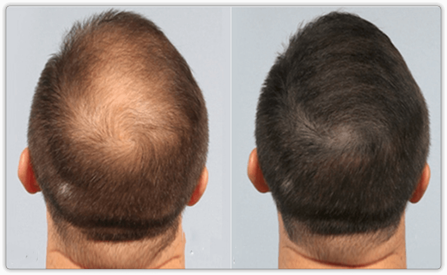 Prp Hair Treatment A Comprehensive Approach To Hair Restoration